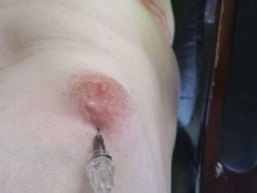 Saline Infusion Scrotum And Titti 3 L 72 Pics Xhamster 1869