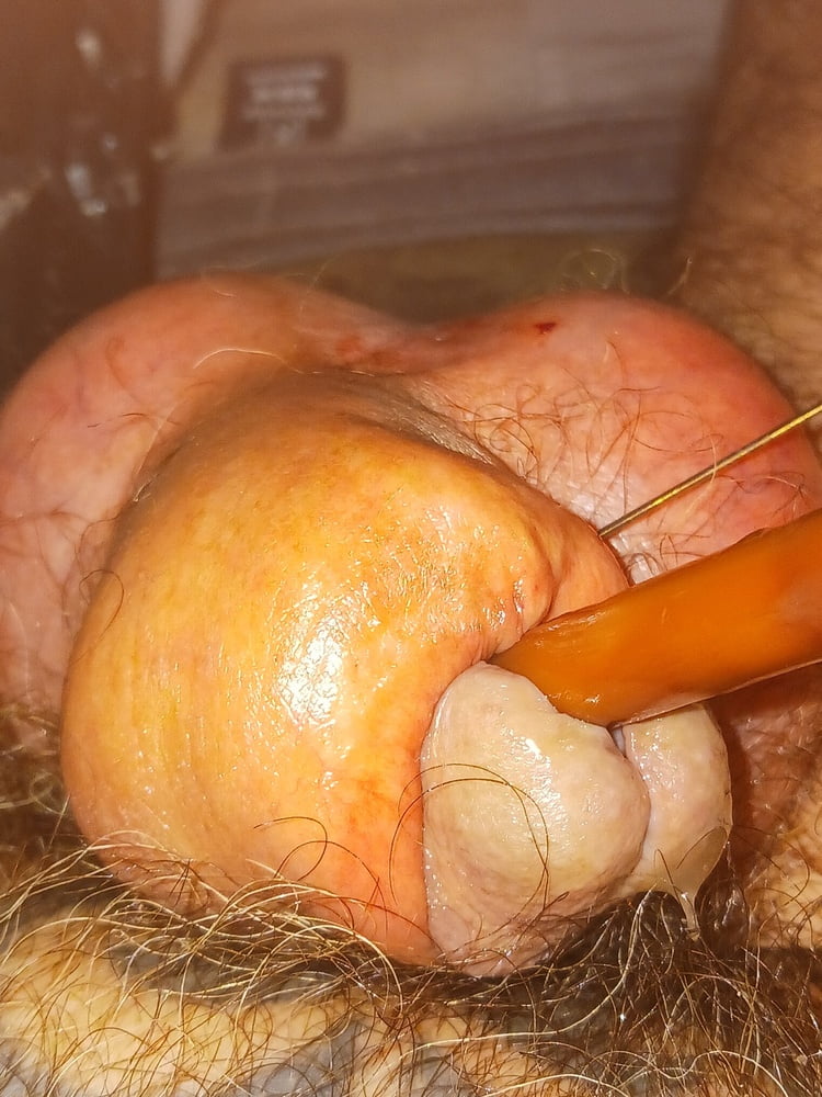 Catheter 2 Pics Xhamster